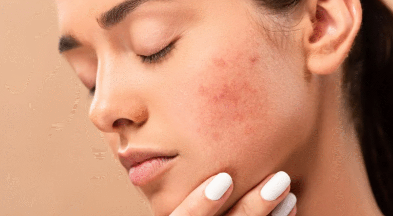 Acne Scar Treatment in Gurgaon: Surgical vs Non-Surgical Options Explained